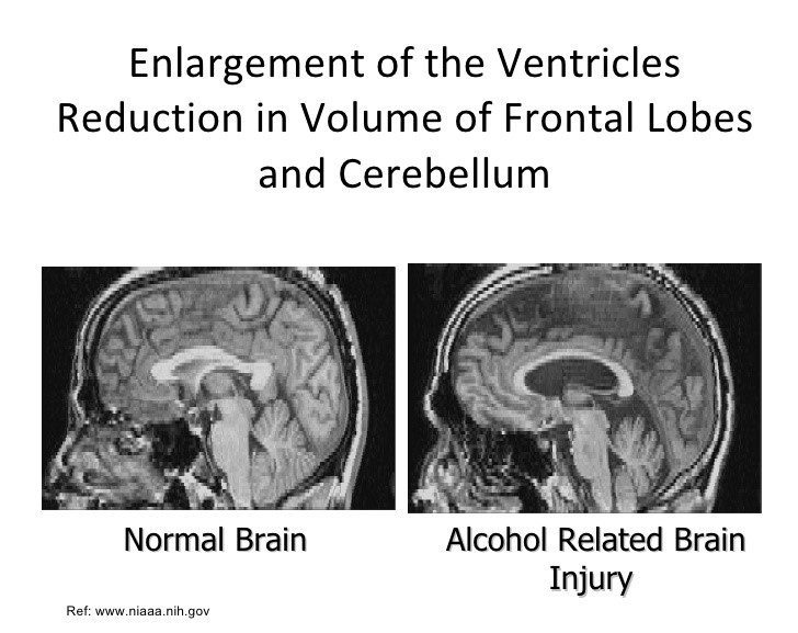 Alcohol Addiction and Alcoholism - Learn More About Alcoholism